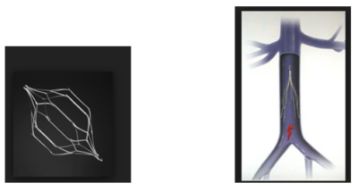 Filtro de vena cava - CACI