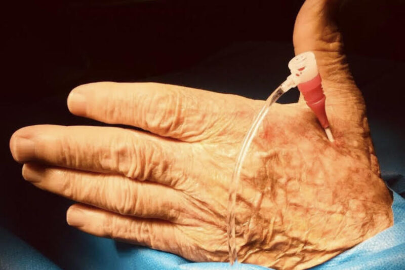 Acceso radial distal: Resultados del ensayo DISCO Radial - CACI