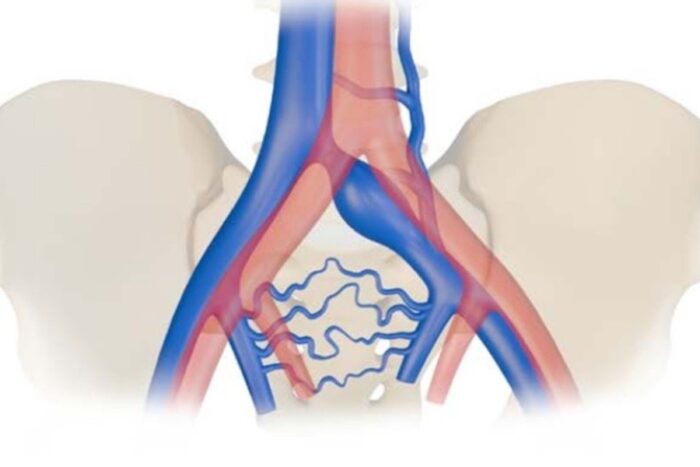 Manejo de los síndromes de compresión extrínseca de la vena ilíaca ...